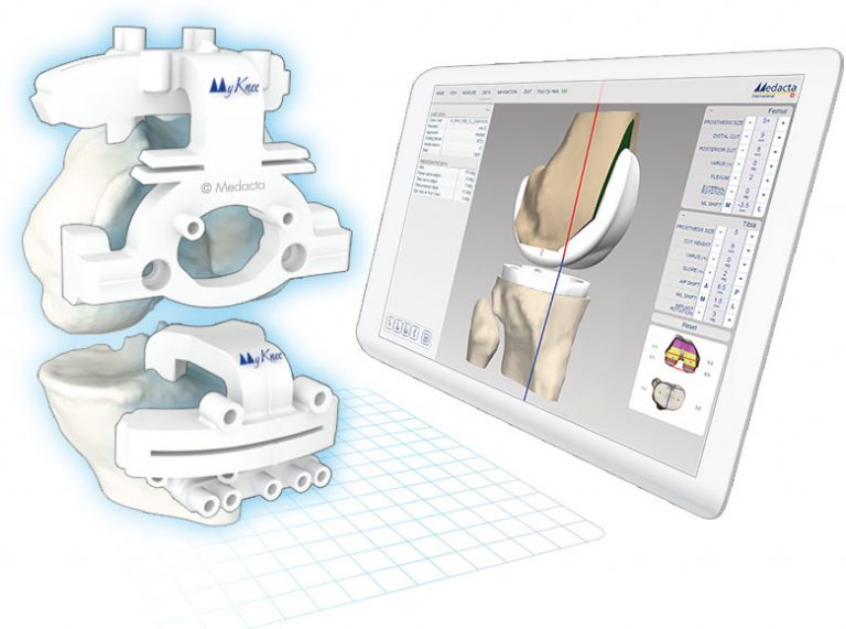 Knieprothese MyKnee — Die Revolution in der Knieprothetik