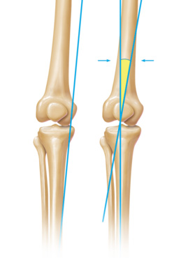 Leg Axis Correction for Knock-Knees and Bow-Legs — Orthopedic Surgeon ...